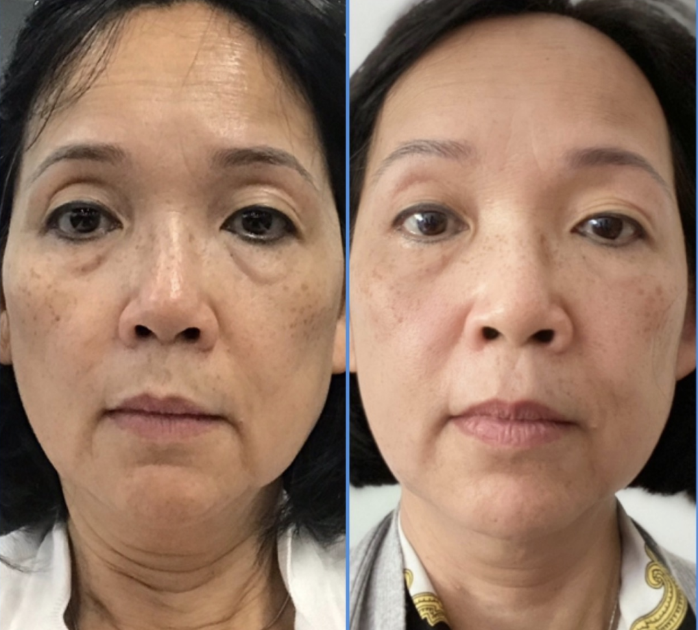 Endosphères Before and After Photos – myArtemis